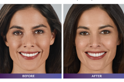 Injectable Fillers | Pinnacle Dermatology